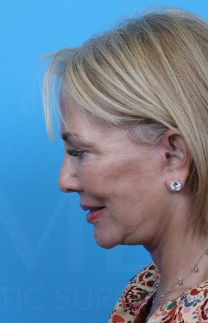 Patient #960 Facelift Before and After Photos Lake Forest - Plastic ...