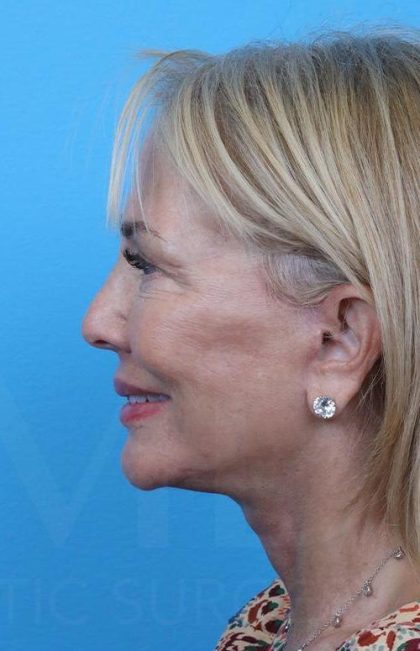 Patient #960 Facelift Before and After Photos Lake Forest - Plastic ...